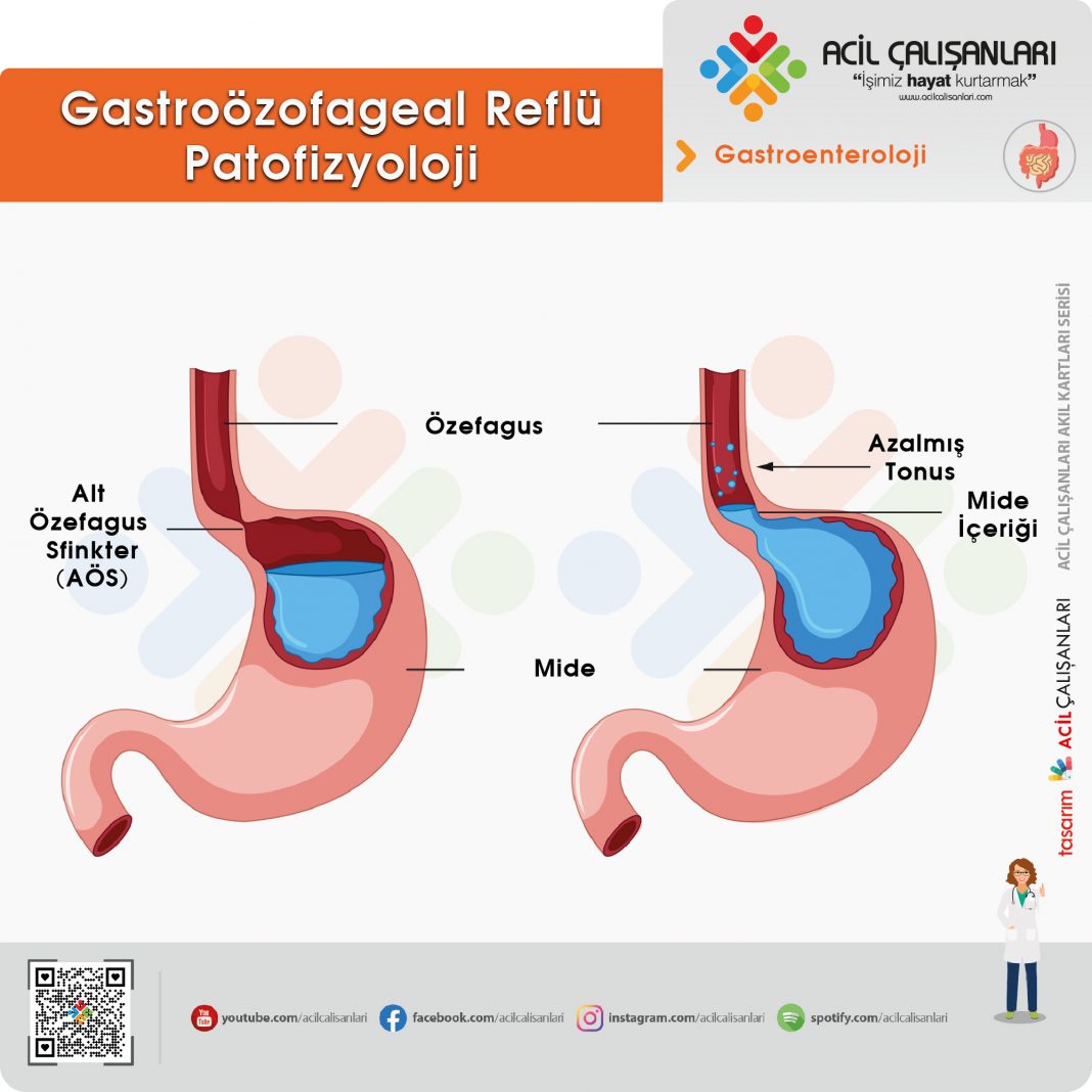 Gastroözofageal Reflü Acil Yaklaşım - Acil Çalışanları