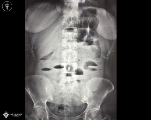 Direkt Batın Grafisi Değerlendirilmesi | Acil Çalışanları