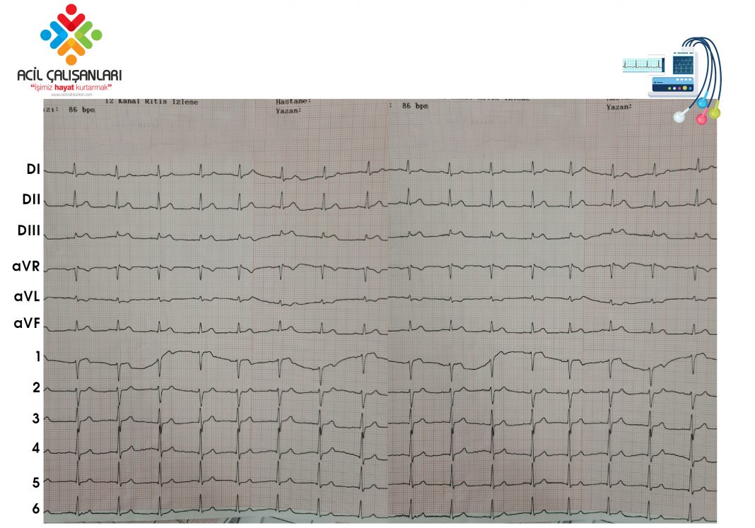 Aslanger EKG Paterni Olgu Sunumu | Acil Çalışanları
