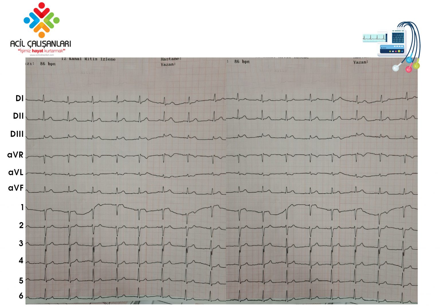 Aslanger EKG Paterni Olgu Sunumu | Acil Çalışanları