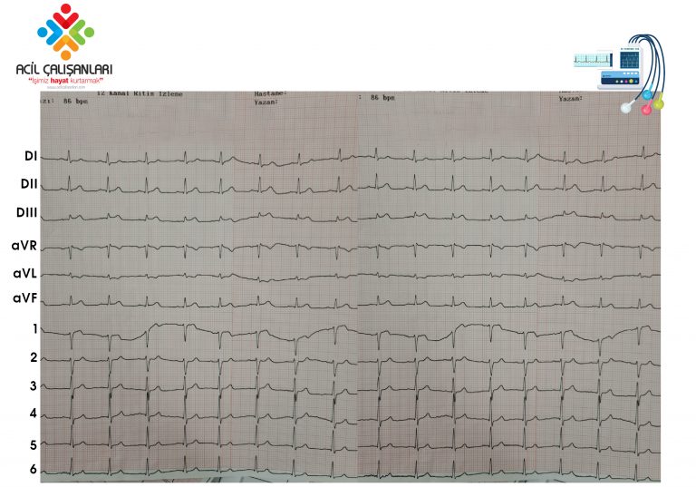Aslanger EKG Paterni Olgu Sunumu | Acil Çalışanları