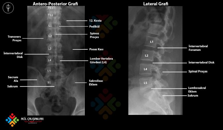 Lumbosakral Grafi Değerlendirme | Acil Çalışanları