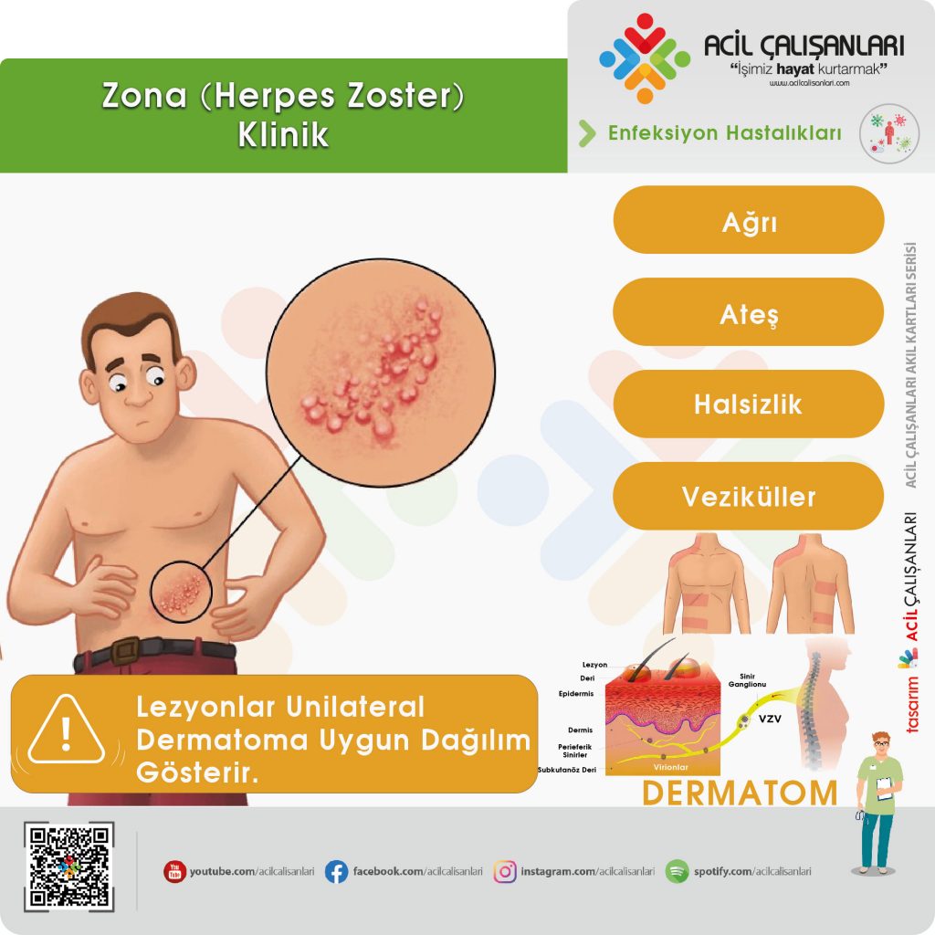Zona (Herpes Zoster) Acil Yaklaşım | Acil Çalışanları