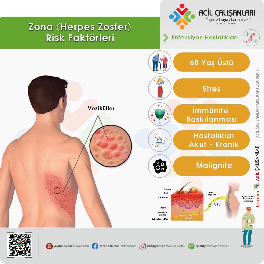 Zona (Herpes Zoster) Acil Yaklaşım | Acil Çalışanları