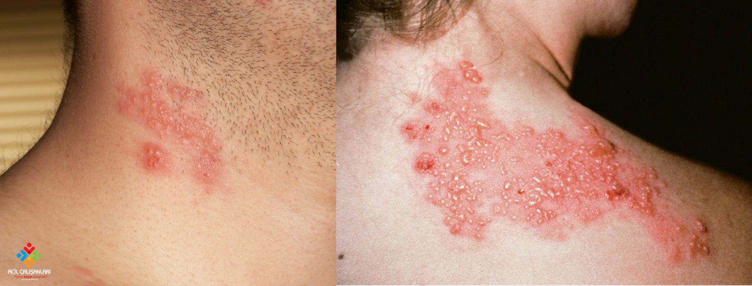 Zona (Herpes Zoster) Acil Yaklaşım | Acil Çalışanları
