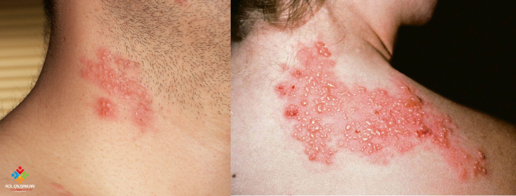 Zona (Herpes Zoster) Acil Yaklaşım | Acil Çalışanları