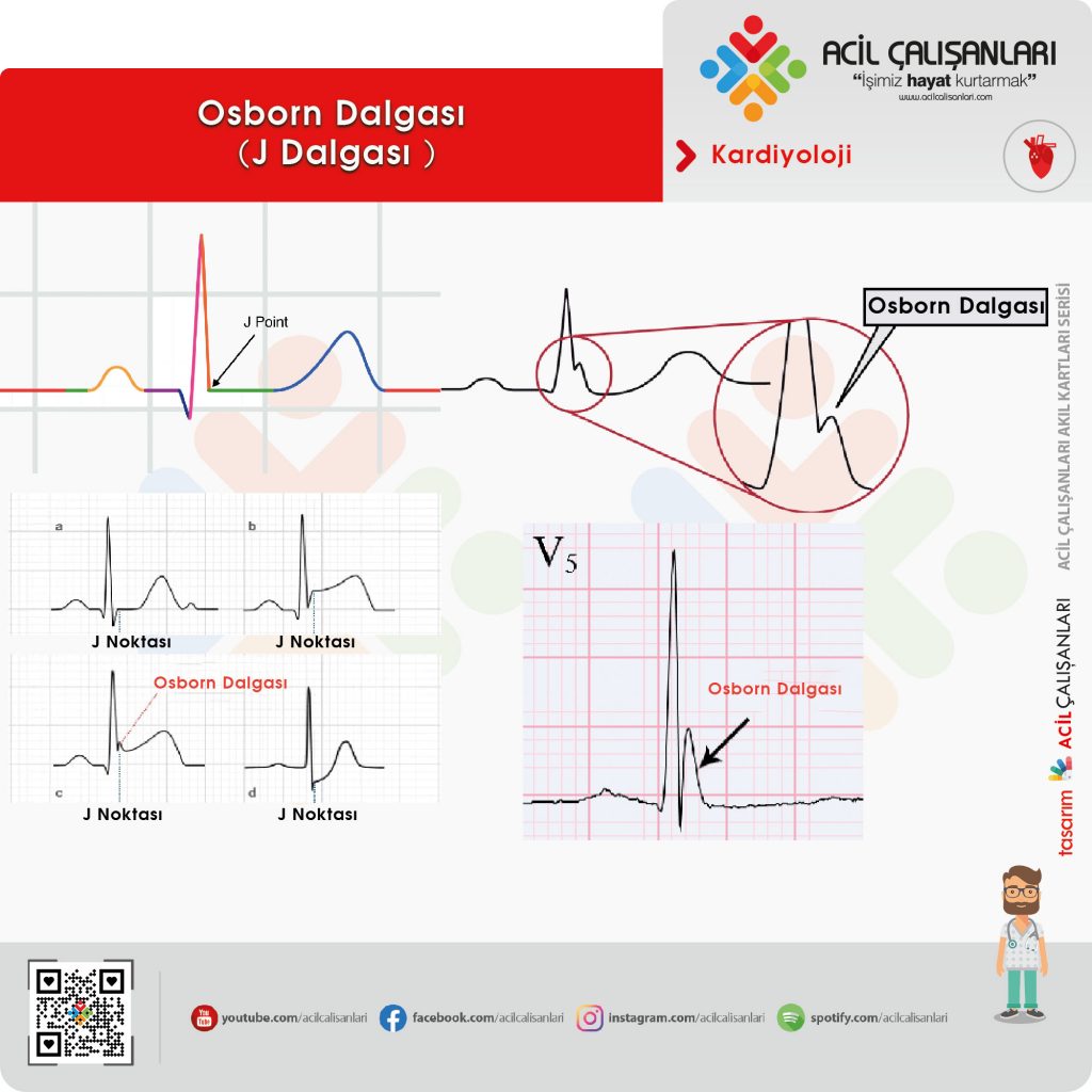 Osborn Dalgası (J Dalgası) - Acil Çalışanları