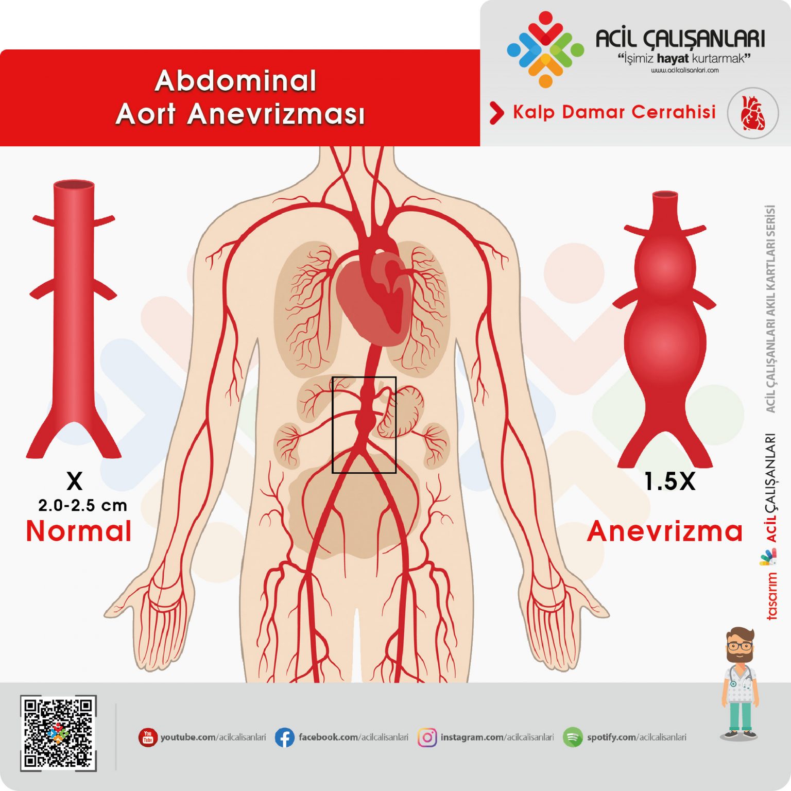 Abdominal Aort Anevrizmasına Acil Yaklaşım | Acil Çalışanları