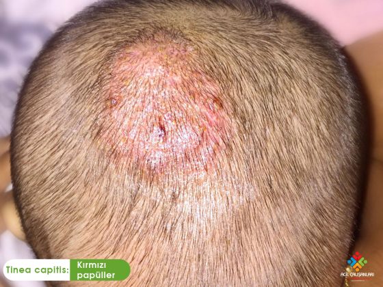Tinea Kapitis (Saçlı Deri Mantarı) | Acil Çalışanları