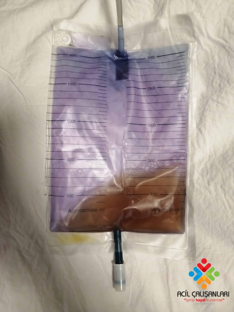 Mor İdrar Torbası Sendromu: Olgu Sunumu | Acil Çalışanları