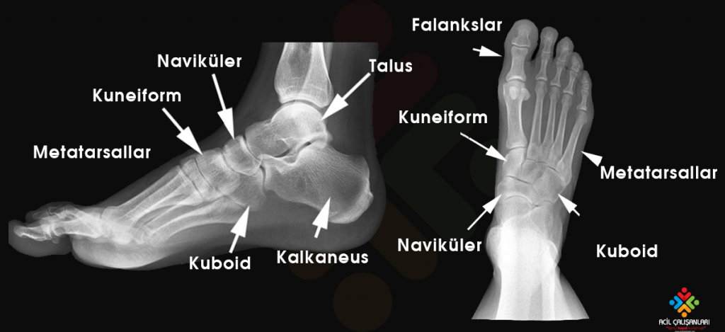Ayak Bileği Grafisi Değerlendirme | Acil Çalışanları