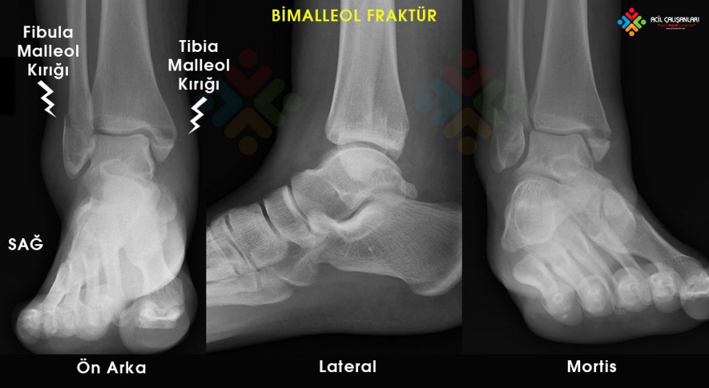 Ayak Bileği Malleol Kırıkları Acil Yaklaşımı - Acil Çalışanları