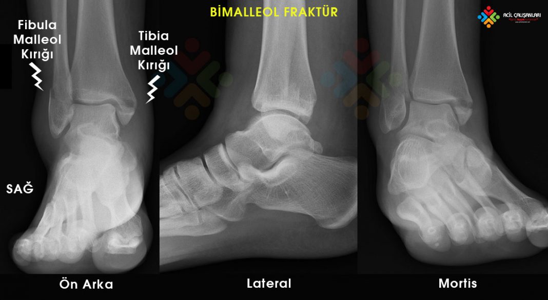 Ayak Bileği Malleol Kırıkları Acil Yaklaşımı - Acil Çalışanları