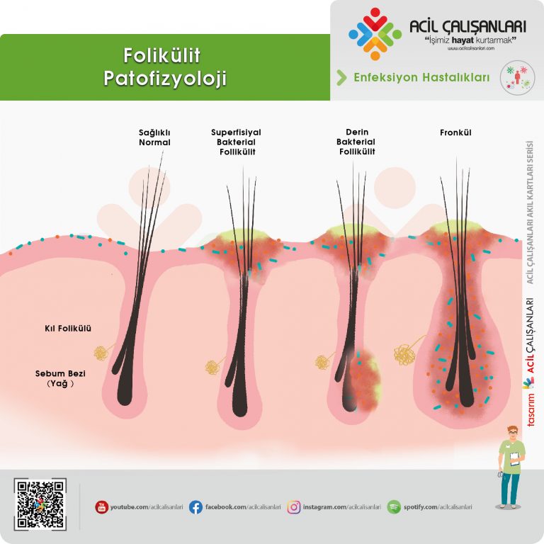 Folikülit Acil Yaklaşım | Acil Çalışanları