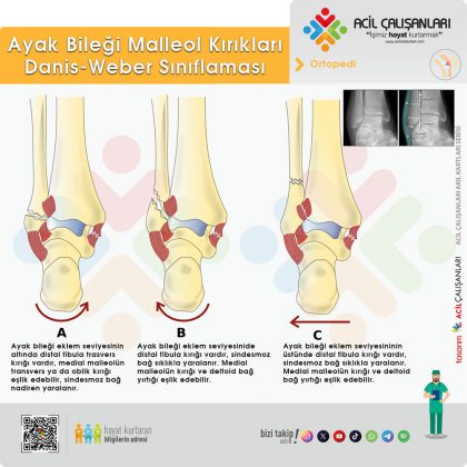 Ayak Bileği Malleol Kırıkları Acil Yaklaşımı - Acil Çalışanları