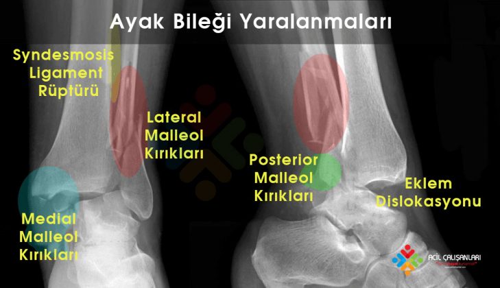 Ayak Bileği Malleol Kırıkları Acil Yaklaşımı - Acil Çalışanları