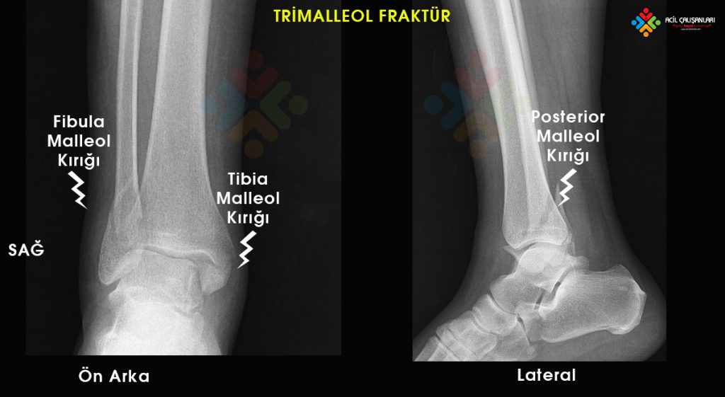 Ayak Bileği Malleol Kırıkları Acil Yaklaşımı - Acil Çalışanları