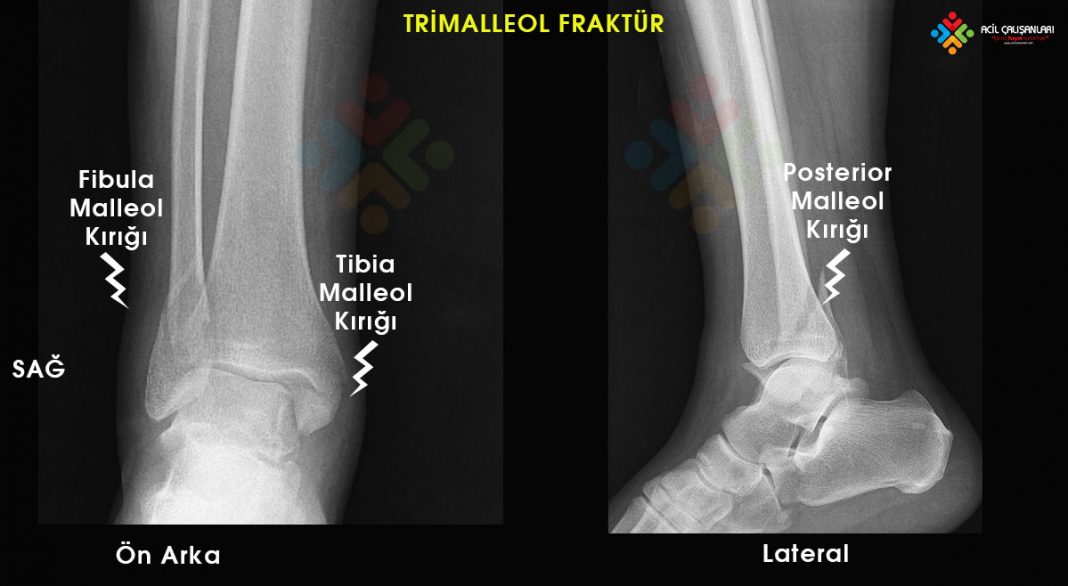 Ayak Bileği Malleol Kırıkları Acil Yaklaşımı - Acil Çalışanları