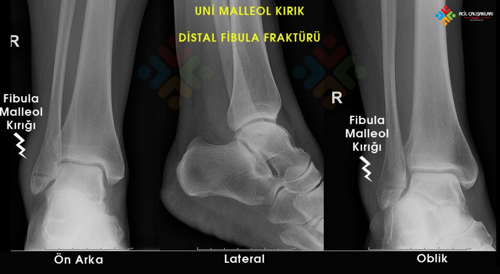 Ayak Bileği Malleol Kırıkları Acil Yaklaşımı - Acil Çalışanları
