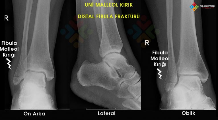 Ayak Bileği Malleol Kırıkları Acil Yaklaşımı - Acil Çalışanları