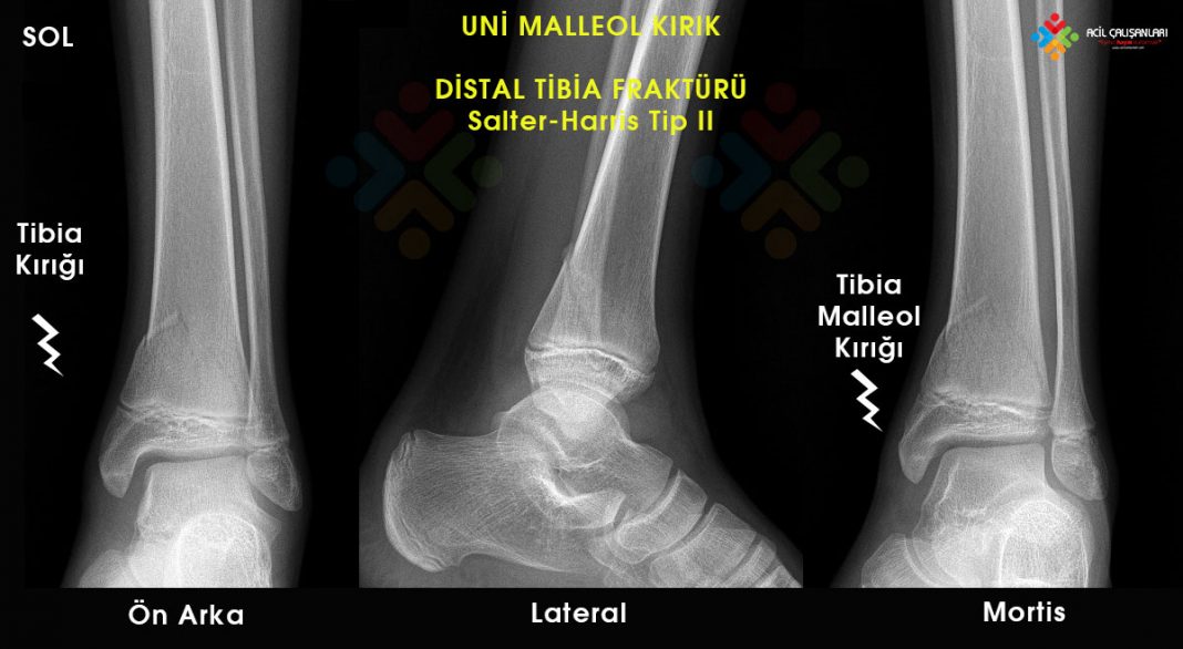 Ayak Bileği Malleol Kırıkları Acil Yaklaşımı - Acil Çalışanları