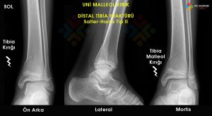 Ayak Bileği Malleol Kırıkları Acil Yaklaşımı - Acil Çalışanları