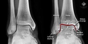 Ayak Bileği Grafisi Değerlendirme | Acil Çalışanları