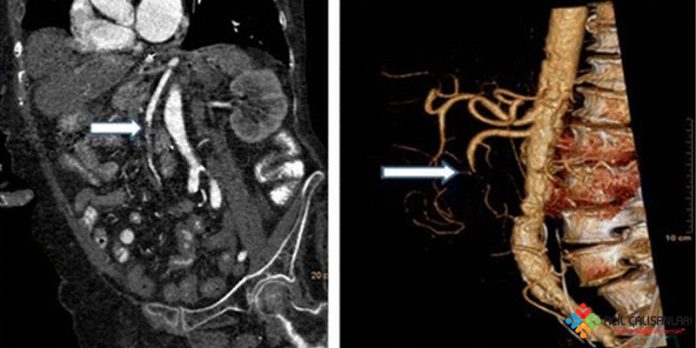 Akut Mezenterik İskemi | Acil Çalışanları