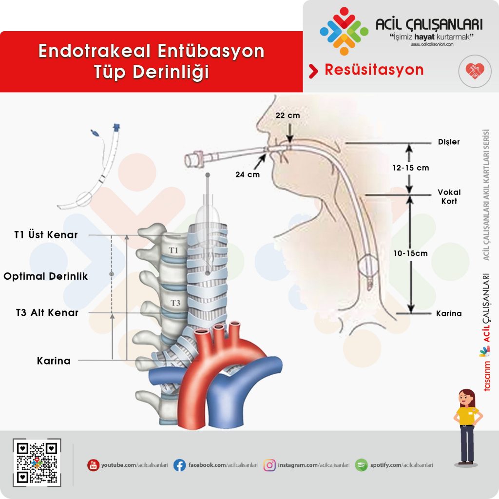 Entübasyonda Endotrakeal Tüpün Yerleşim Doğruluğu ve Derinliği - Acil ...
