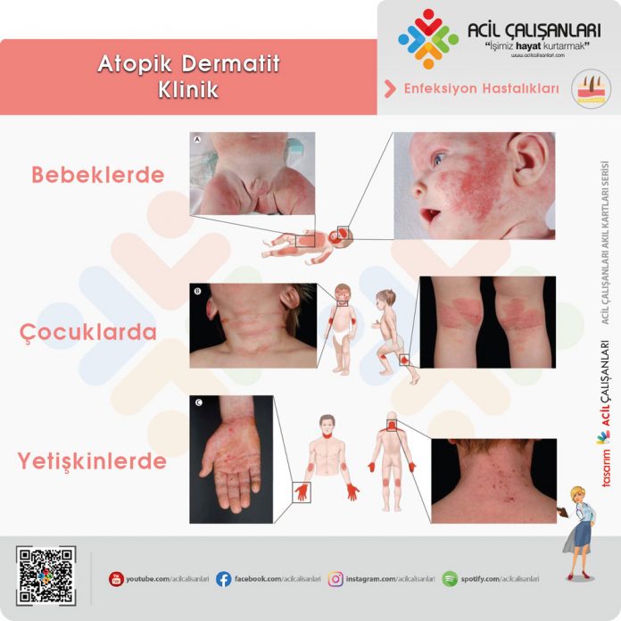 Atopik Dermatit (Egzema) Acil Yaklaşım | Acil Çalışanları