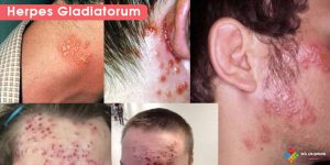 Herpes Enfeksiyonları | Acil Çalışanları