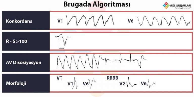 Brugada Algoritması Ventriküler Taşikardi (VT) | Acil Çalışanları