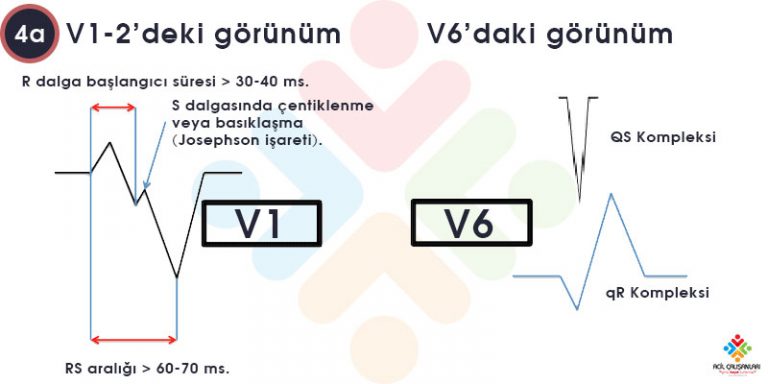 Brugada Algoritması Ventriküler Taşikardi (VT) | Acil Çalışanları