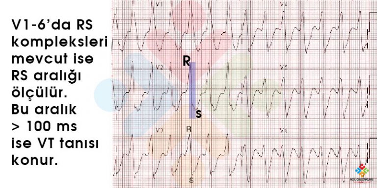 Brugada Algoritması Ventriküler Taşikardi (VT) | Acil Çalışanları