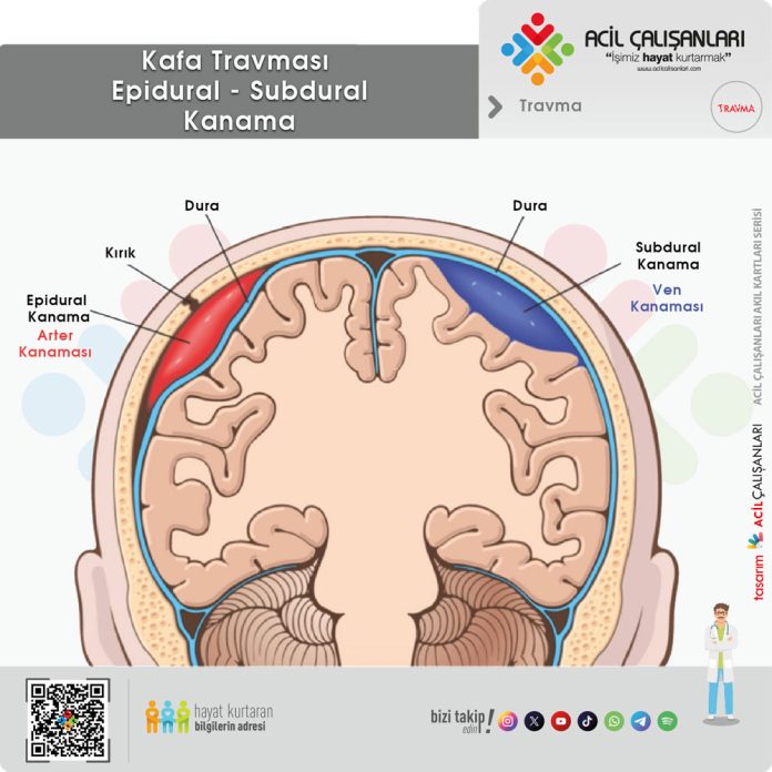 Subdural Kanama Akıl Kartı | Acil Çalışanları