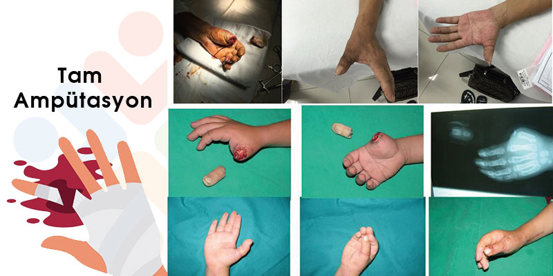 Parmak Amputasyonları Acil Yaklaşım | Acil Çalışanları