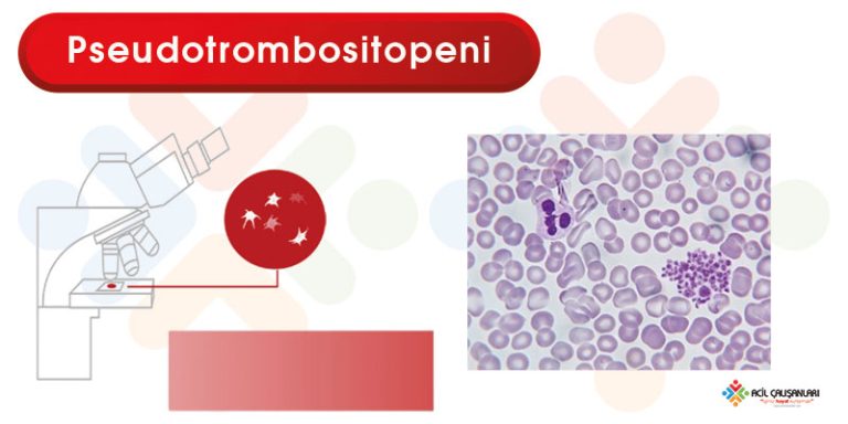Trombositopeni Acil Yaklaşım | Acil Çalışanları