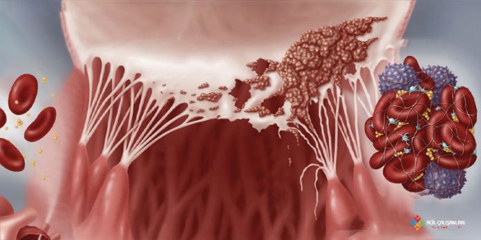 Endokardit Acil Yaklaşım | Acil Çalışanları