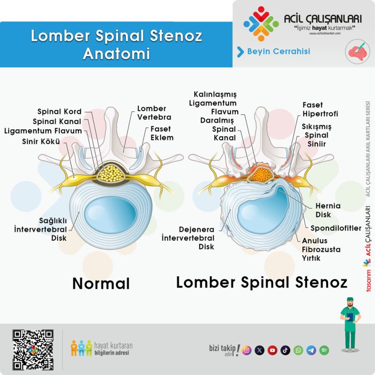 Bel Fıtığı (Lomber Spinal Stenoz) Acil Yaklaşım - Acil Çalışanları