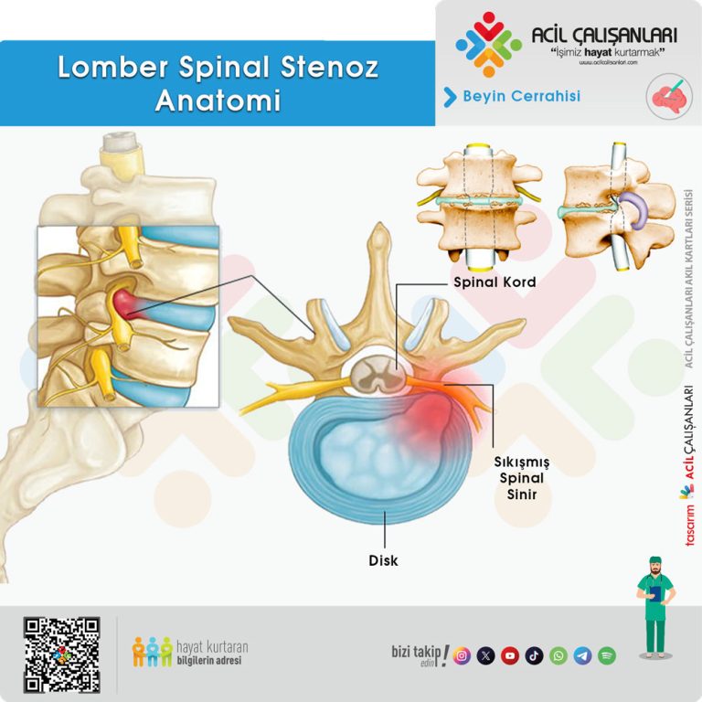 Bel Fıtığı (Lomber Spinal Stenoz) Acil Yaklaşım | Acil Çalışanları