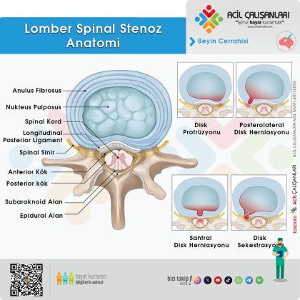 Bel Fıtığı (Lomber Spinal Stenoz) Acil Yaklaşım | Acil Çalışanları
