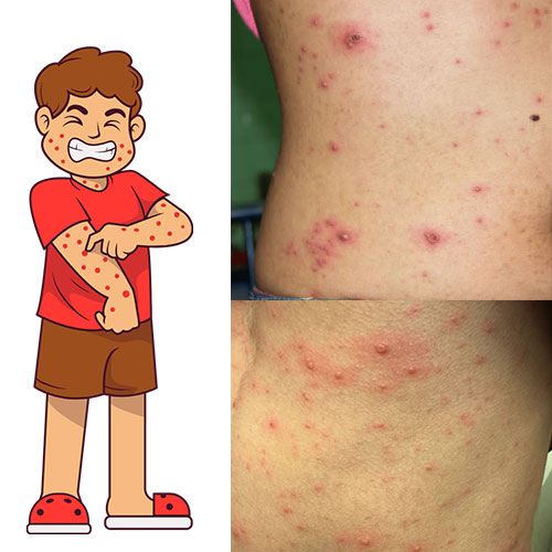 Su Çiçeği (Varisella Zoster) | Acil Çalışanları