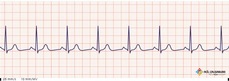QRS Aralığı - Acil Çalışanları