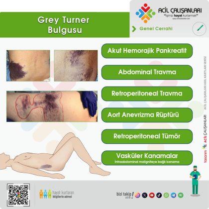 Grey Turner (Sign) Bulgusu | Acil Çalışanları
